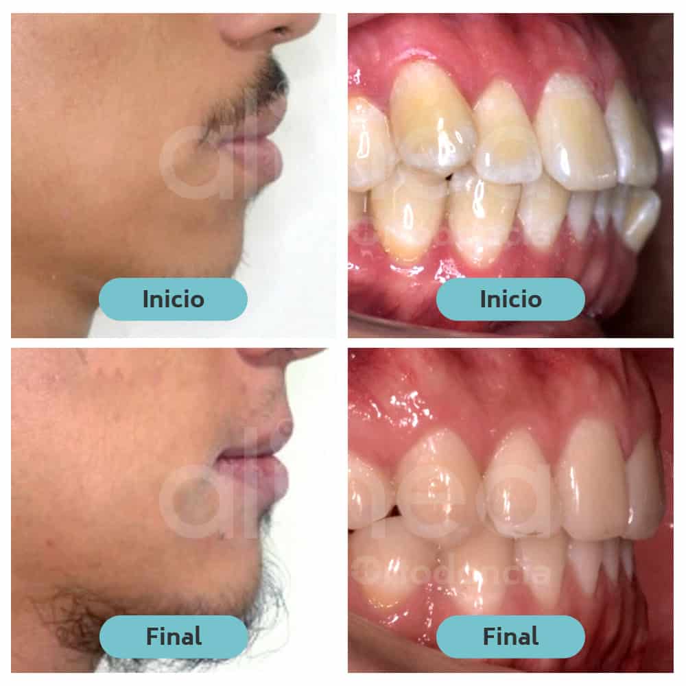 Alinea Ortodoncia – Clínica Alinea Visión y Dental en Lima