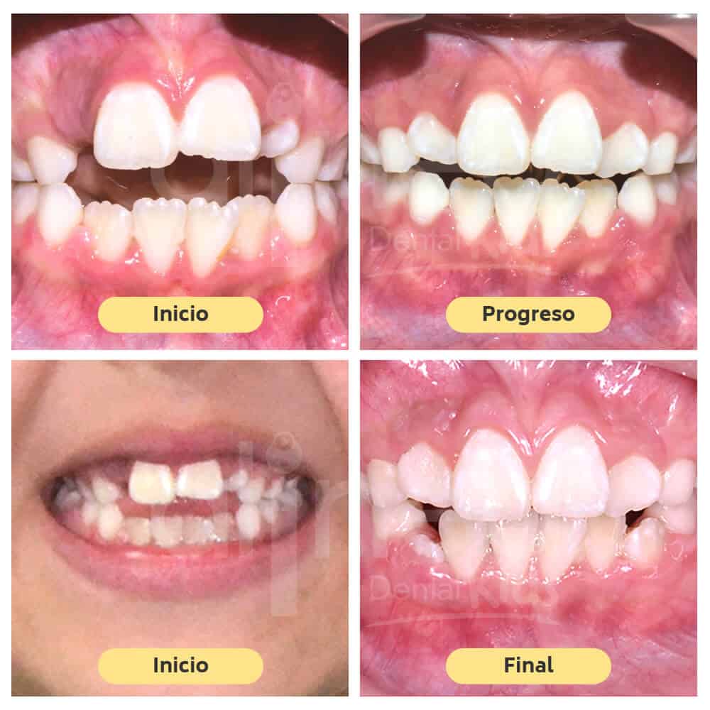 Alinea dental kids – Clínica Alinea Visión y Dental en Lima