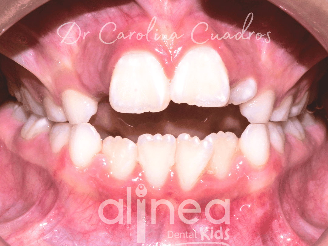 Succión del Dedo en Niños: Entendiendo el Hábito y sus Consecuencias en ...