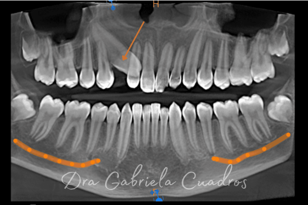 Caso Clínico – Canino retenido – Clínica Alinea Visión y Dental en Lima