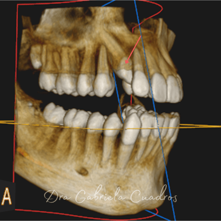 Caso Clínico – Canino retenido – Clínica Alinea Visión y Dental en Lima