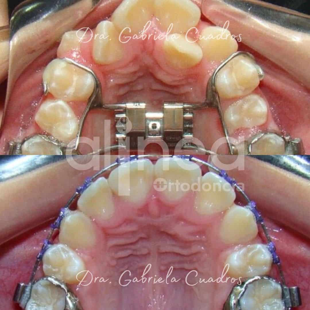 Expansor Del Paladar Inferior