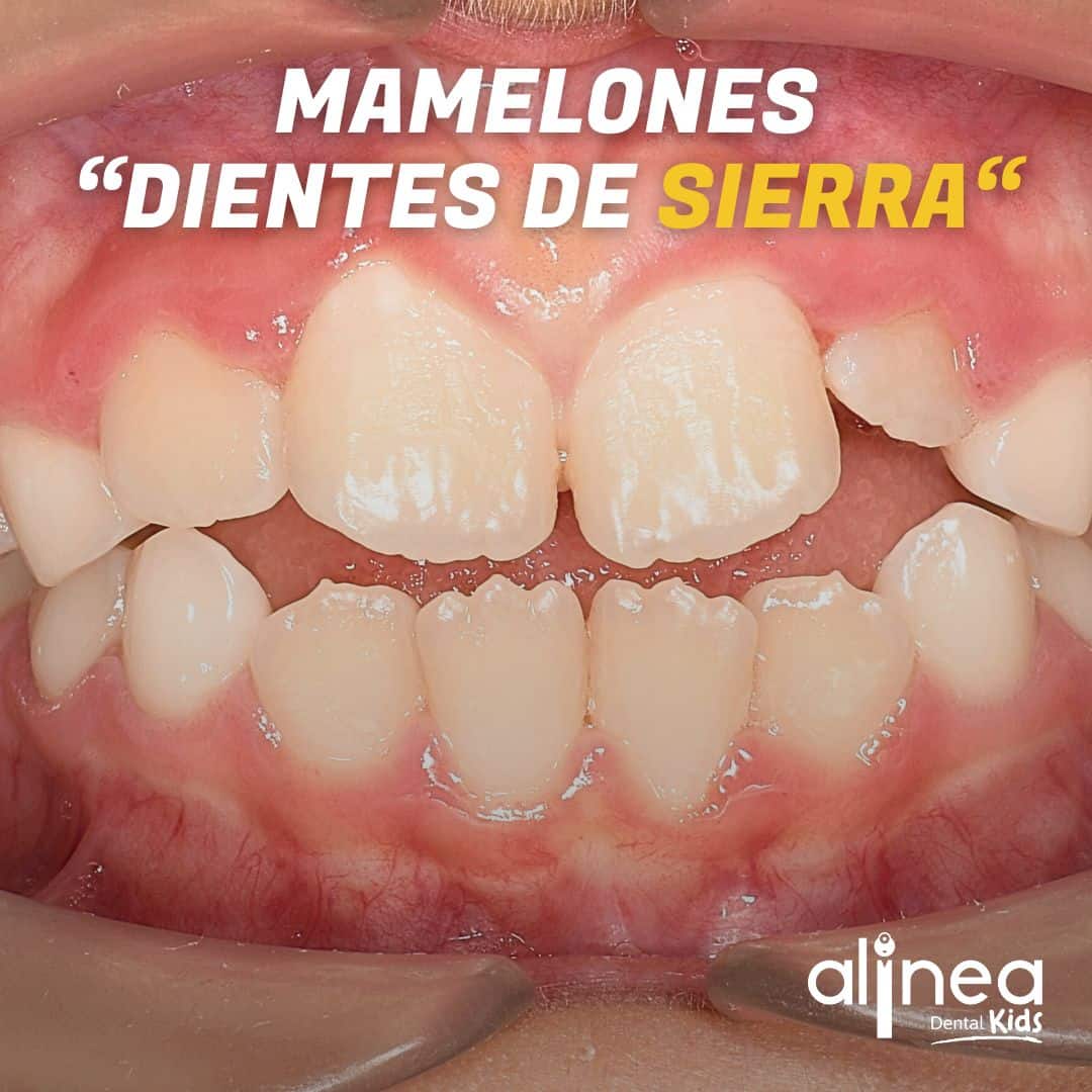 Los Mamelones Dentales en Niños: ¿Qué Son y Cómo Afectan la Salud Bucal ...