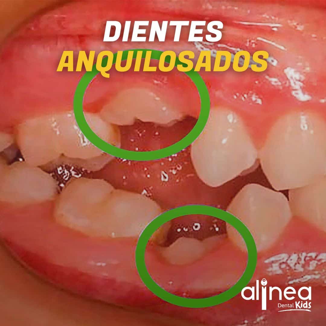 Alinea Dental Kids: Comprendiendo los Dientes Anquilosados en Niños ...