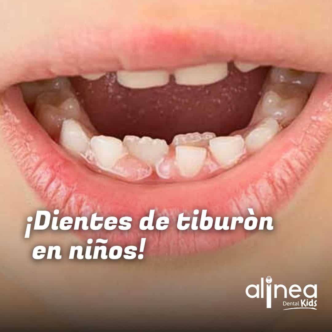 Dientes en Doble Fila o «Dientes de Tiburón» en Niños: ¿Qué Debes Saber ...