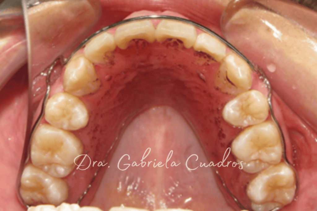 La Importancia de los Retenedores en Ortodoncia: todo lo que debes ...