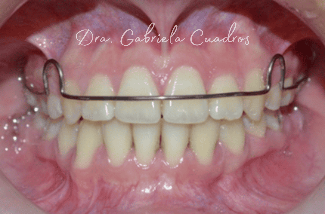 La Importancia de los Retenedores en Ortodoncia: todo lo que debes ...