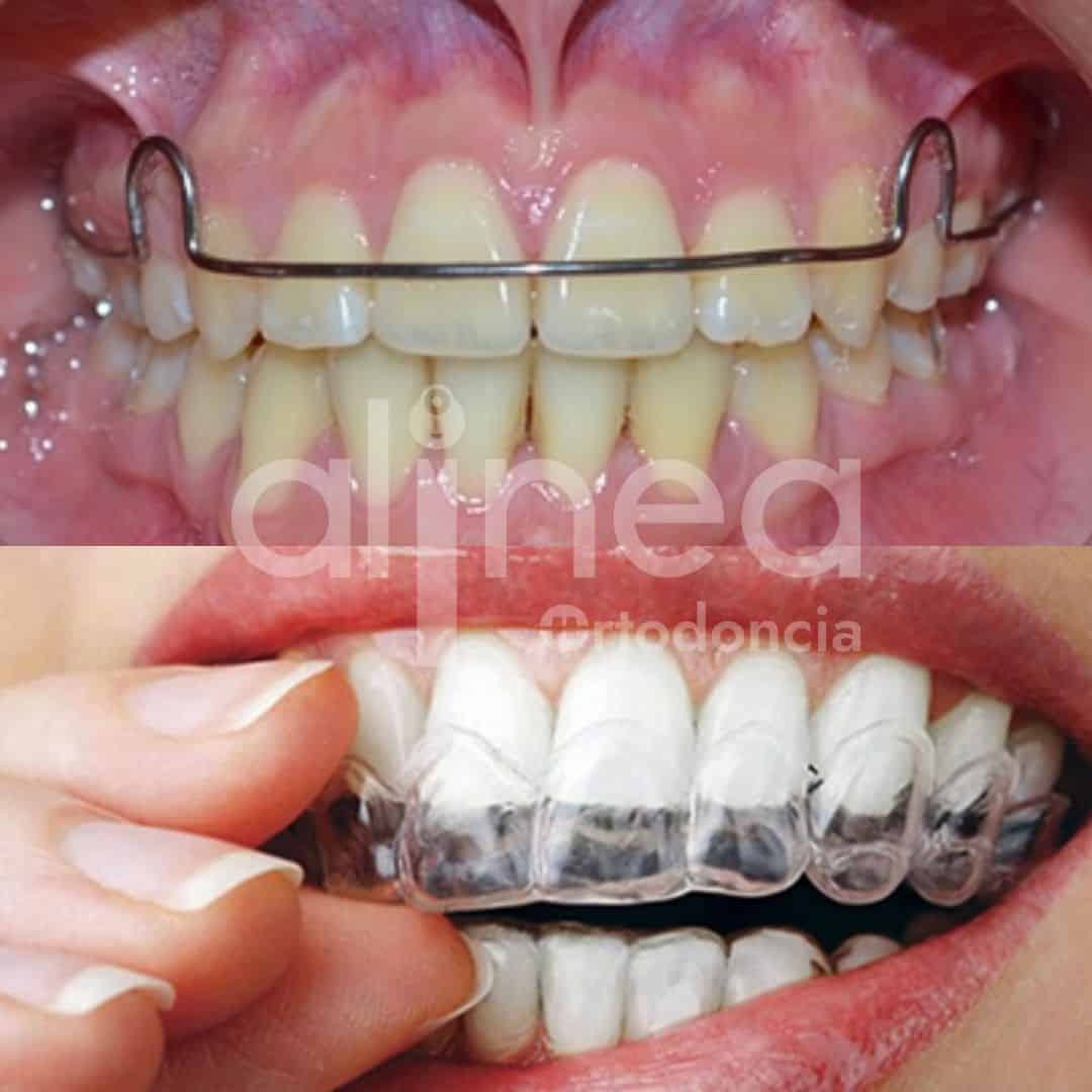 La Importancia de los Retenedores en Ortodoncia: todo lo que debes ...