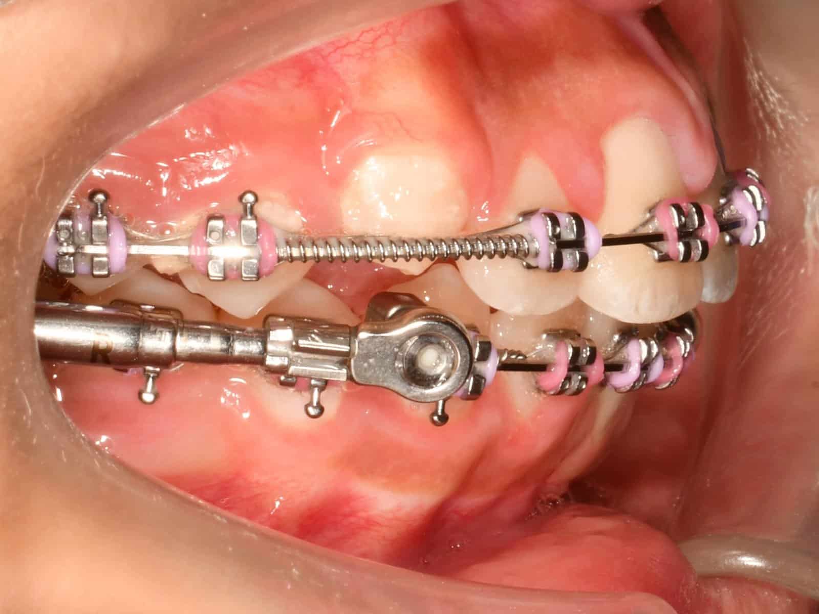 Alinea Dental Kids: Explorando la Retrognatia Mandibular en Niños ...