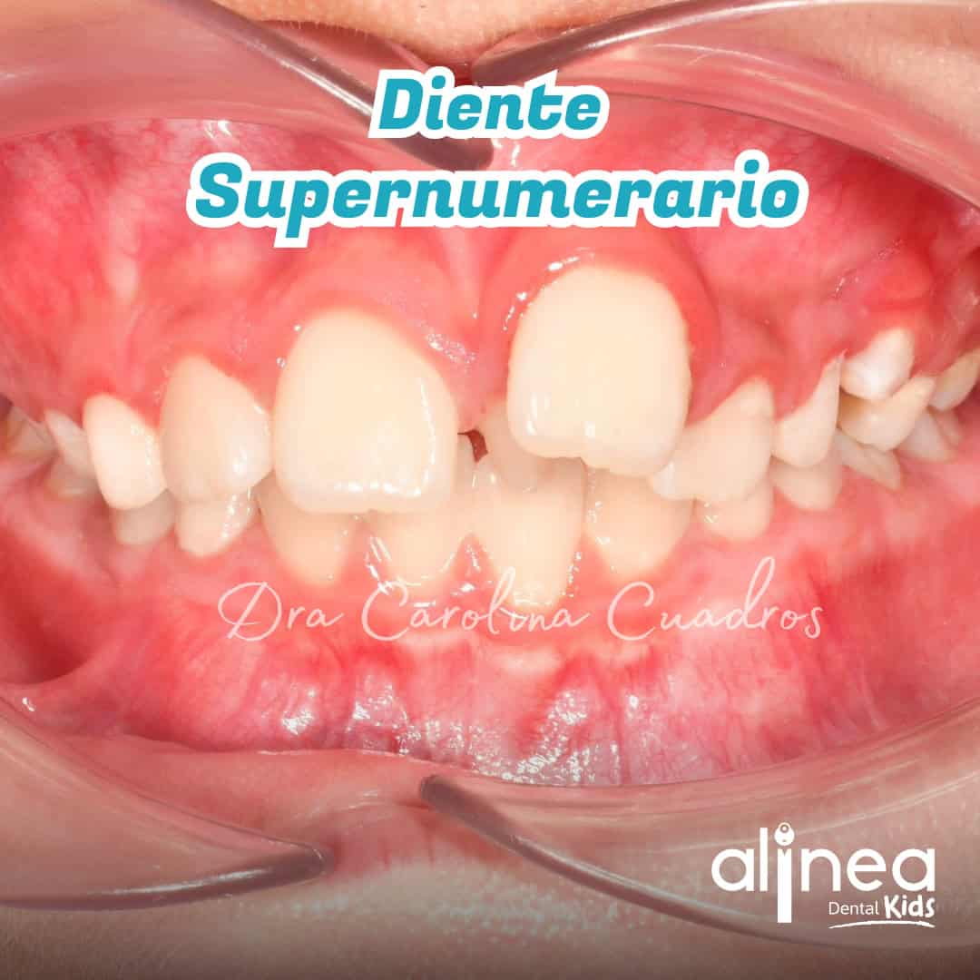Dientes Supernumerarios en Niños – Clínica Alinea Visión y Dental en Lima