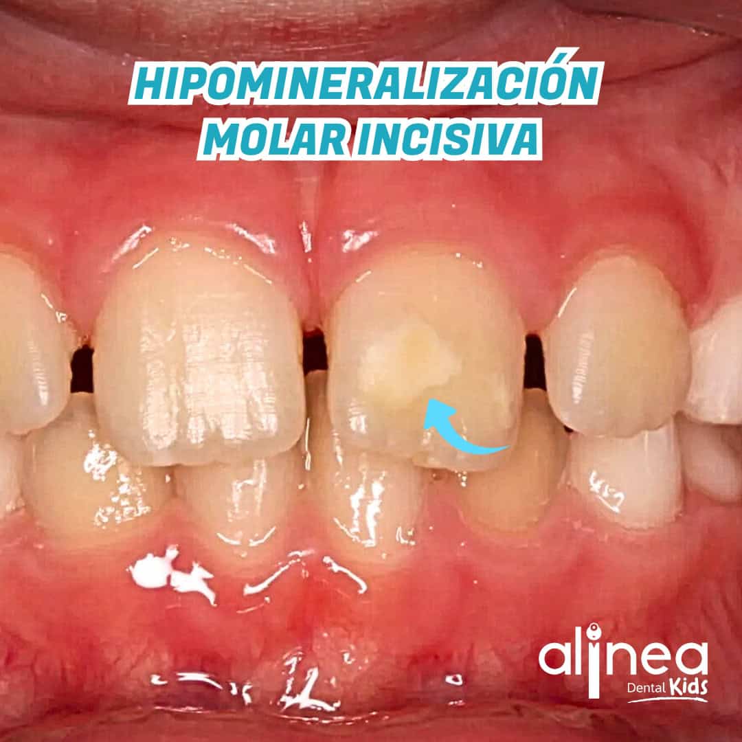 Descubriendo la Hipomineralización Molar Incisiva: Alinea Dental Kids ...