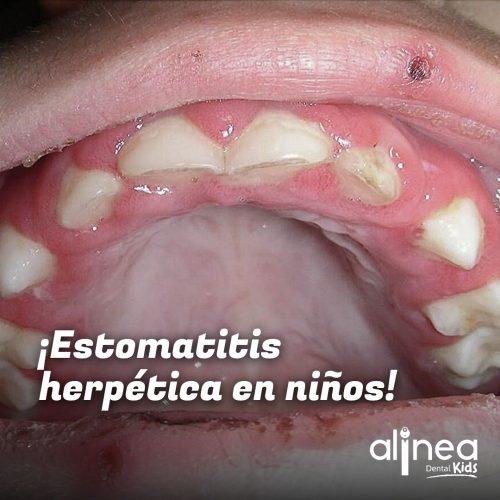 Abordando la Estomatitis Herpética en Niños: Causas, Síntomas y ...